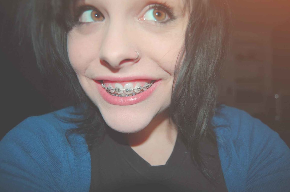 Teen Braces - Full Pro Guide 2025 - BracesBoss